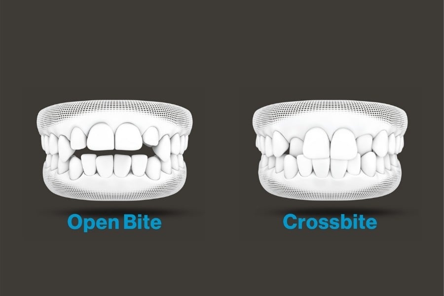 How Right is Your Bite? 8 Cases Invisalign Can Fix