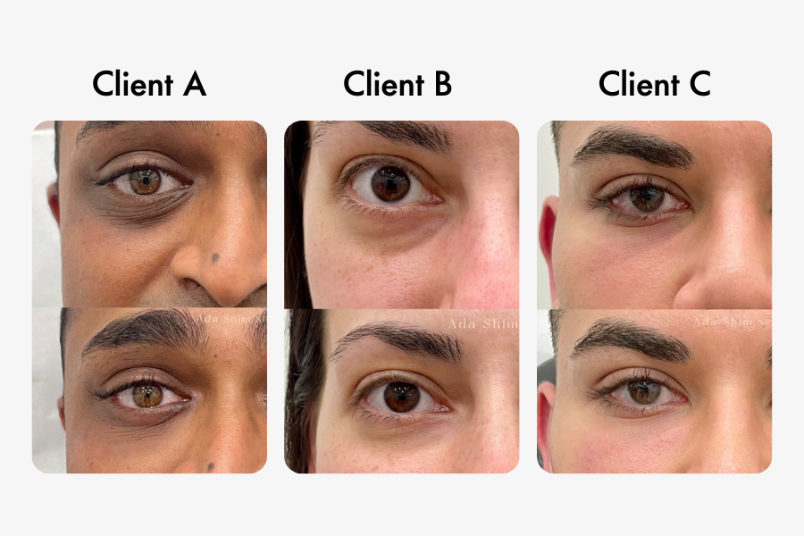 Instant Refresh: The Magic of Under-Eye Filler Explained